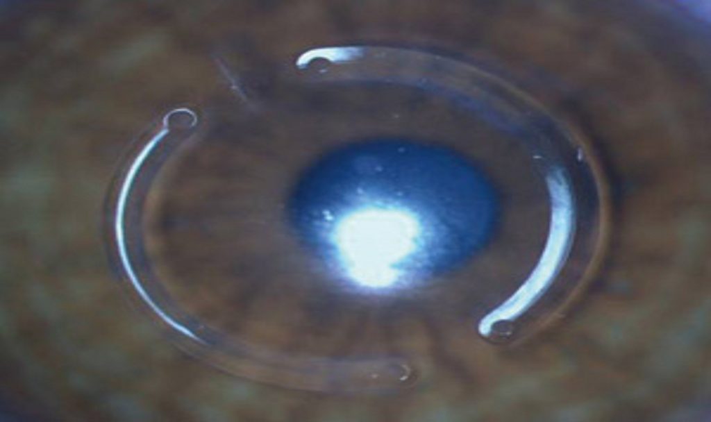 Intracorneal Rings – Laser vision me