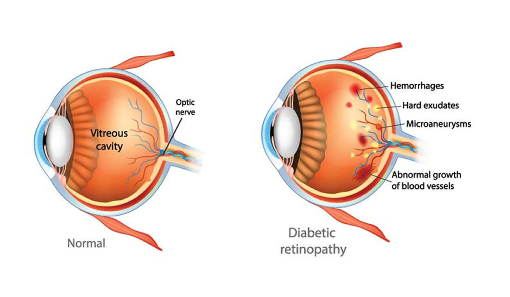 Diabetic Retinopathy – Laser vision
