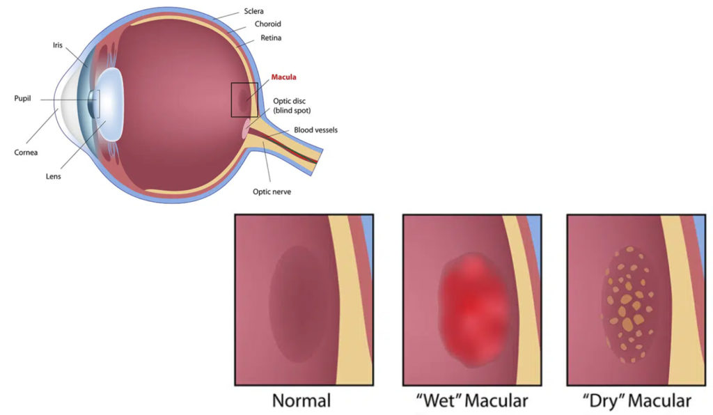 AMD – Laser vision me