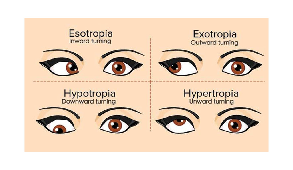Strabismus – Laser vision me Strabismus – Laser vision me